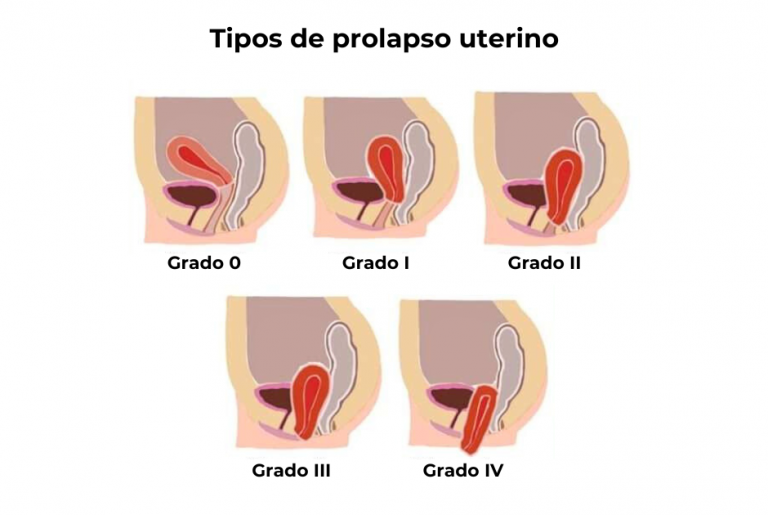 Prolapso uterino: abordaje integral con radiofrecuencia - CAPENERGY MEDICAL